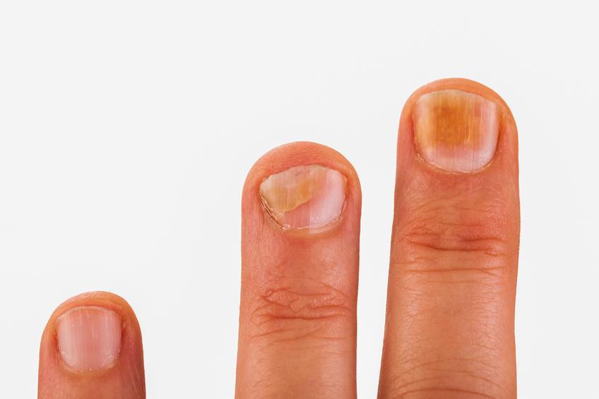 Unhas com RISCOS: Por que Surgem e o Que Significam