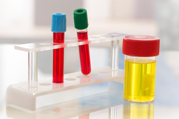 Presença de MUCO na urina: 9 CAUSAS POSSÍVEIS