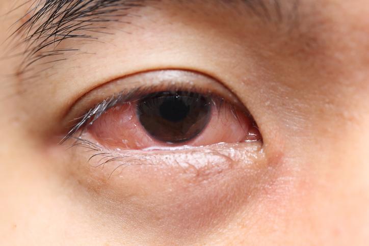 Olhos inchados por alergia: Causas, tratamento e remédios