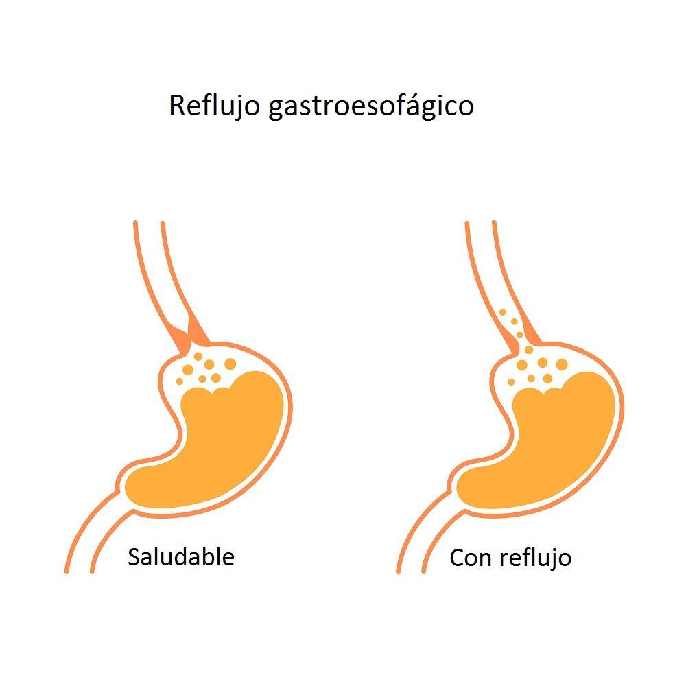 Refluxo gastroesofágico: tratamento, sintomas e causas